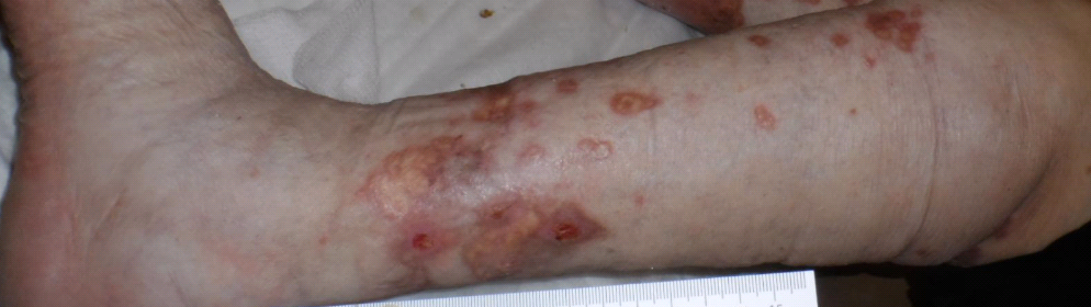 Don't Miss This - Necrobiosis Lipoidica Diabeticorum - Caroline Fife M.D.