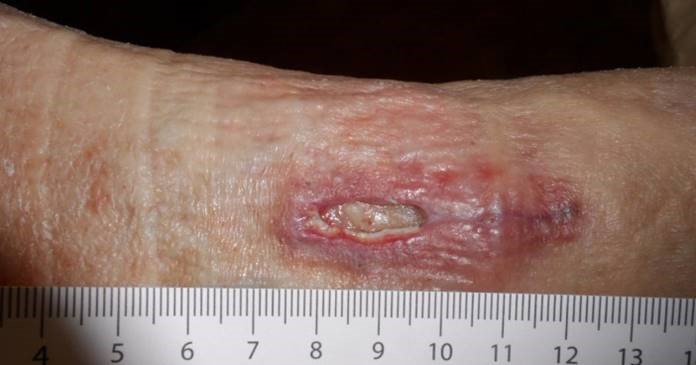 Wound Whisperer: Shhhh... My Secret Vitamin D Treatment for a Surgical ...