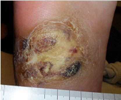 Chance Favors the Prepared Mind... and Why Wound Care is a Game of Duck ...