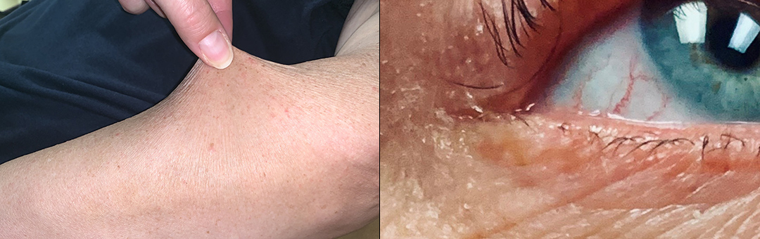 I Missed It! Ehlers-Danlos Syndrome as the Cause of Wound Healing ...