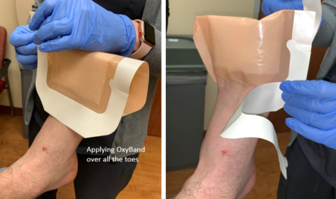 Use of Transdermal Oxygen (OxyBand) for Distal Toe Re-attachment ...
