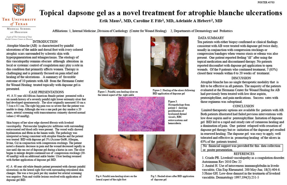 Hope for Atrophie Blanche with Compounded Topical Dapsone and Aspirin ...
