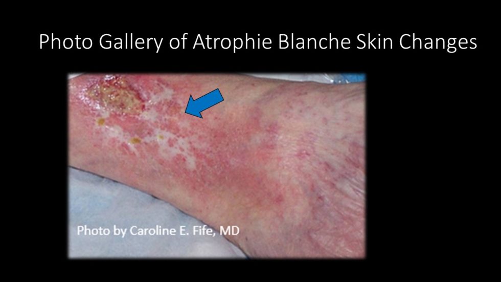 Hope for Atrophie Blanche with Compounded Topical Dapsone and Aspirin ...