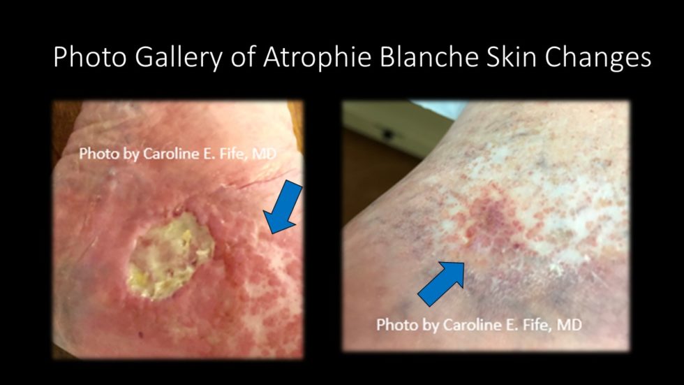 Hope for Atrophie Blanche with Compounded Topical Dapsone and Aspirin ...