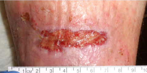 The Many Faces of Pyoderma Grangrenosum - a Leg Ulcer Present for a ...