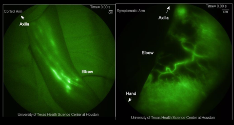 The (Mostly) Complete Guide to Lymphatic Anatomy Part 1: Why We Need ...