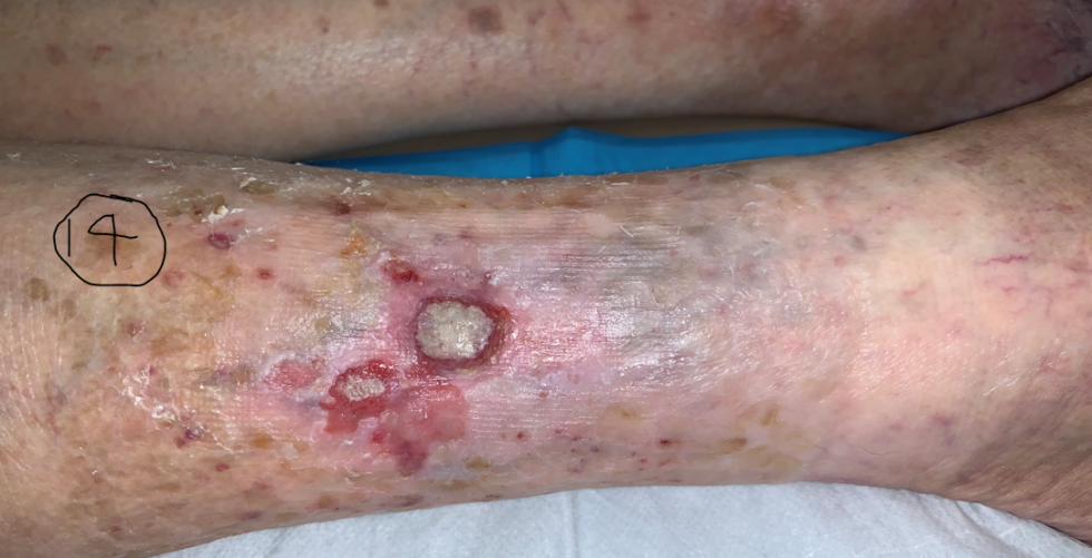 Try This! A Clinical Scoring Tool to Diagnose Pyoderma Gangrenosum ...