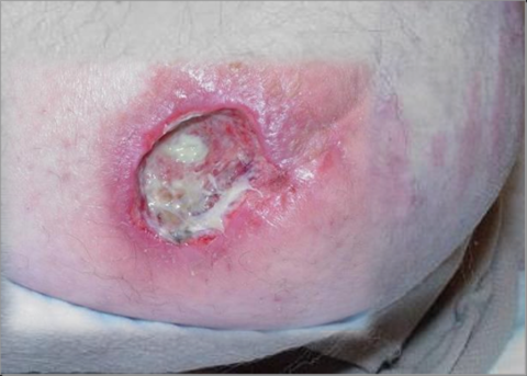 Warning - Don’t Watch This Unless You Want to See How Stage 4 Pressure ...